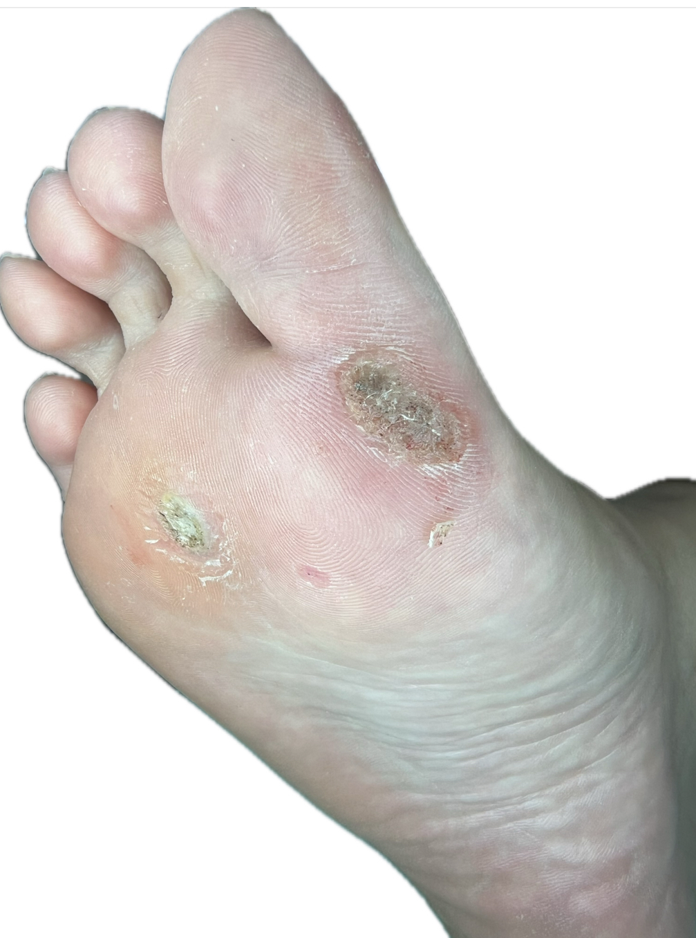 Verruca – General Foot Care